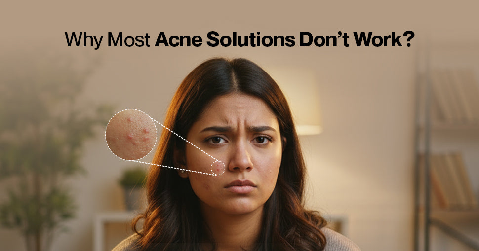 Why Most Acne Solutions Don't Work (and What Actually Does) – Setu ...