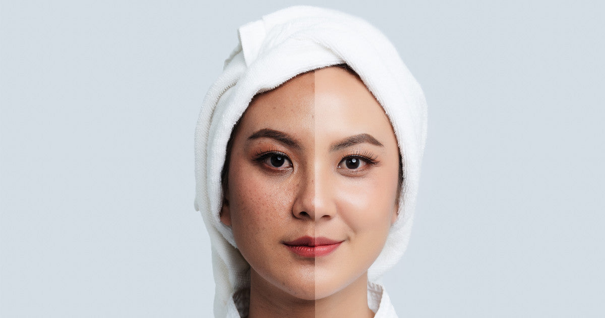 These 4 Natural Ingredients Are Great for Reducing Pigmentation – Setu ...